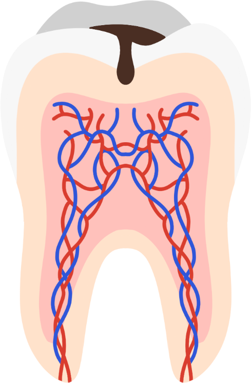 How Do Dentists Fix Tooth Decay? - Dentfix